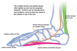 CMT and Your Feet: Surgery Sometimes, Bracing Often, Caution Always ...