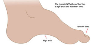 CMT and Your Feet: Surgery Sometimes, Bracing Often, Caution Always ...