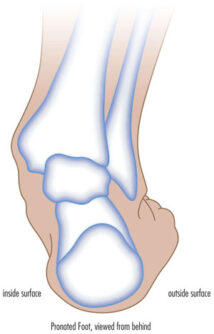 CMT and Your Feet: Surgery Sometimes, Bracing Often, Caution Always ...