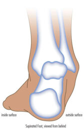 CMT and Your Feet: Surgery Sometimes, Bracing Often, Caution Always ...